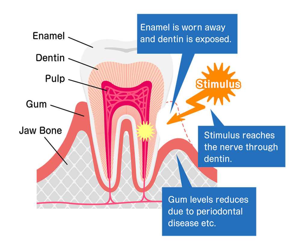 Causes of Tooth Sensitivity - Century Smile Dental
