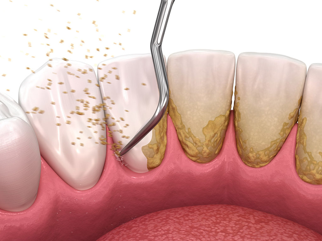 Teeth Cleaning in Culver City CA - Century Smile Dental