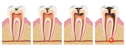 What Are Dental Caries? - Century Smile Dental